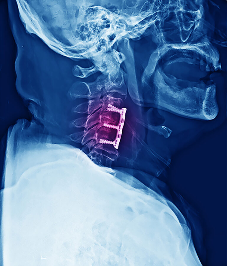 Anterior Cervical Discectomy & Fusion (ACDF) in New Jersey