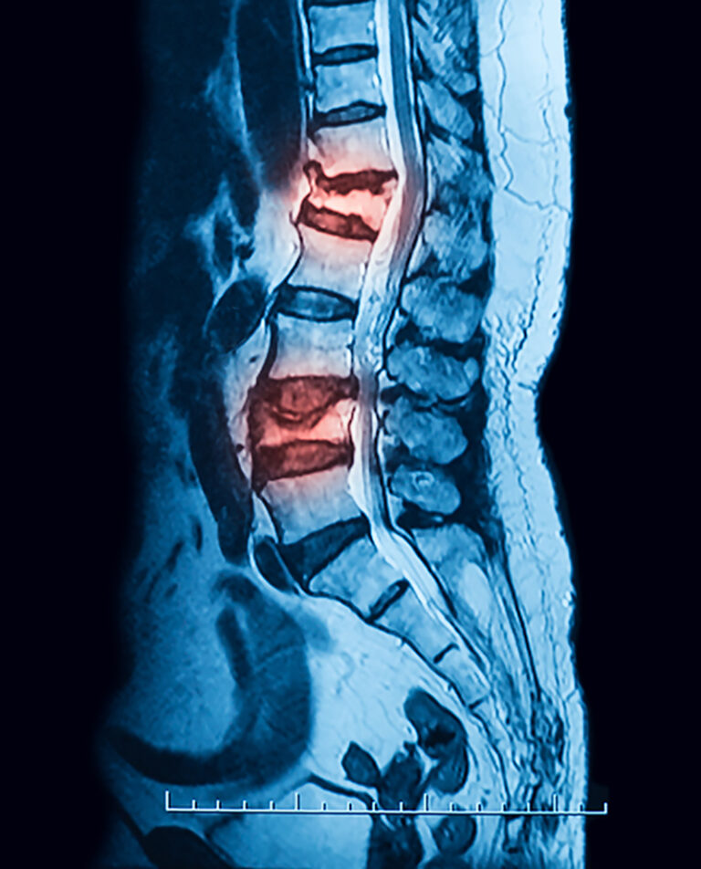 Vertebral Fractures Treatment NJ | Spinal Compression Fracture Therapies