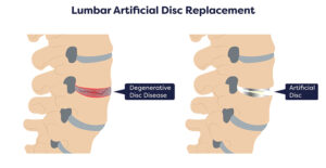 Disc Replacement Surgery NJ | Artificial Disc Replacement Specialist in ...