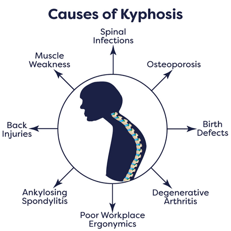 Kyphosis Treatment in New Jersey