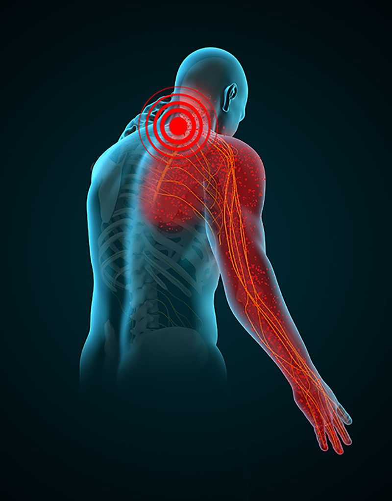 Radiculopathy Surgery In NJ And NYC