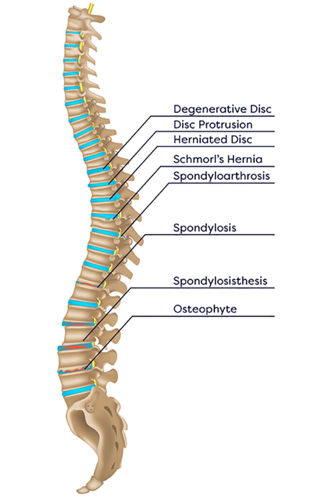 Spine Conditions - Premier Brain & Spine