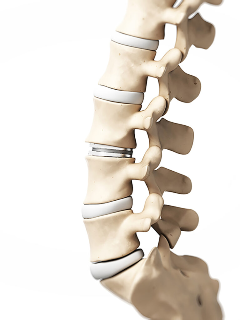 Spine Procedures - Premier Brain & Spine