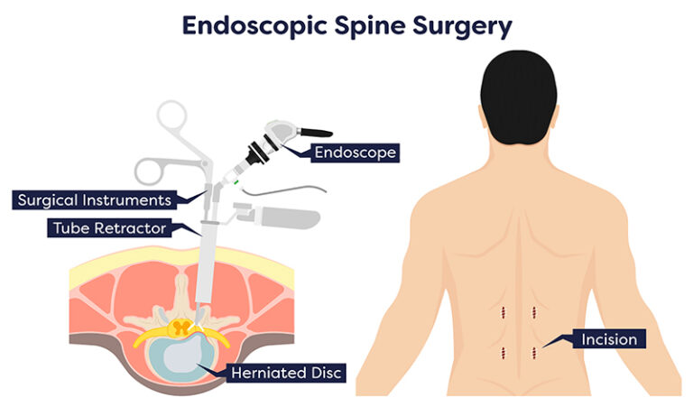 Minimally Invasive & Endoscopic Spine Surgery in Edison, NJ | Premier ...